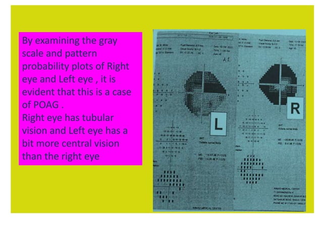 Visual field analysis--interpretation | PPTX | Eye and Vision ...
