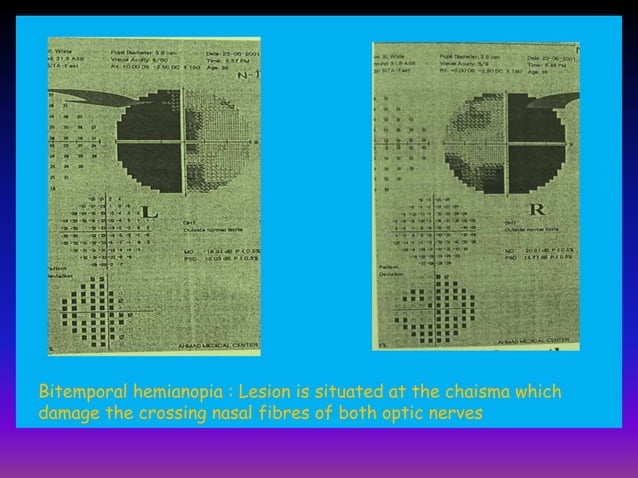 Visual field analysis--interpretation | PPTX | Eye and Vision ...