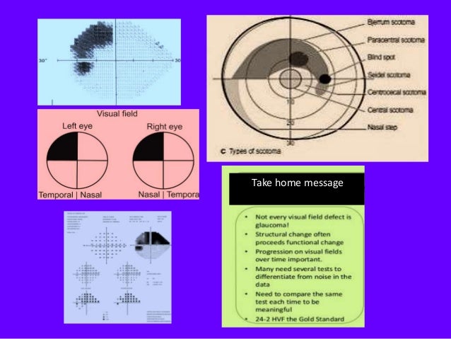 Visual field analysis--interpretation