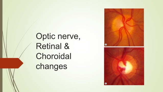 Visual field assessment,optic nerve changes and retinal changes | PPTX