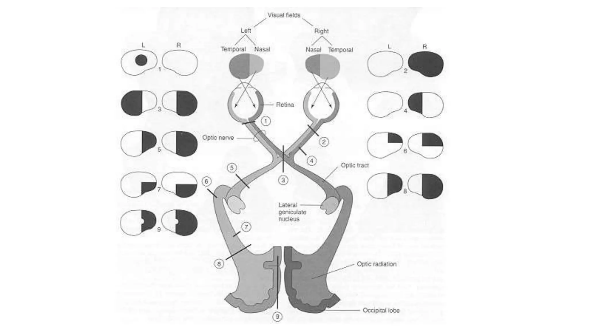 Visual field basics & interpretation | PPTX