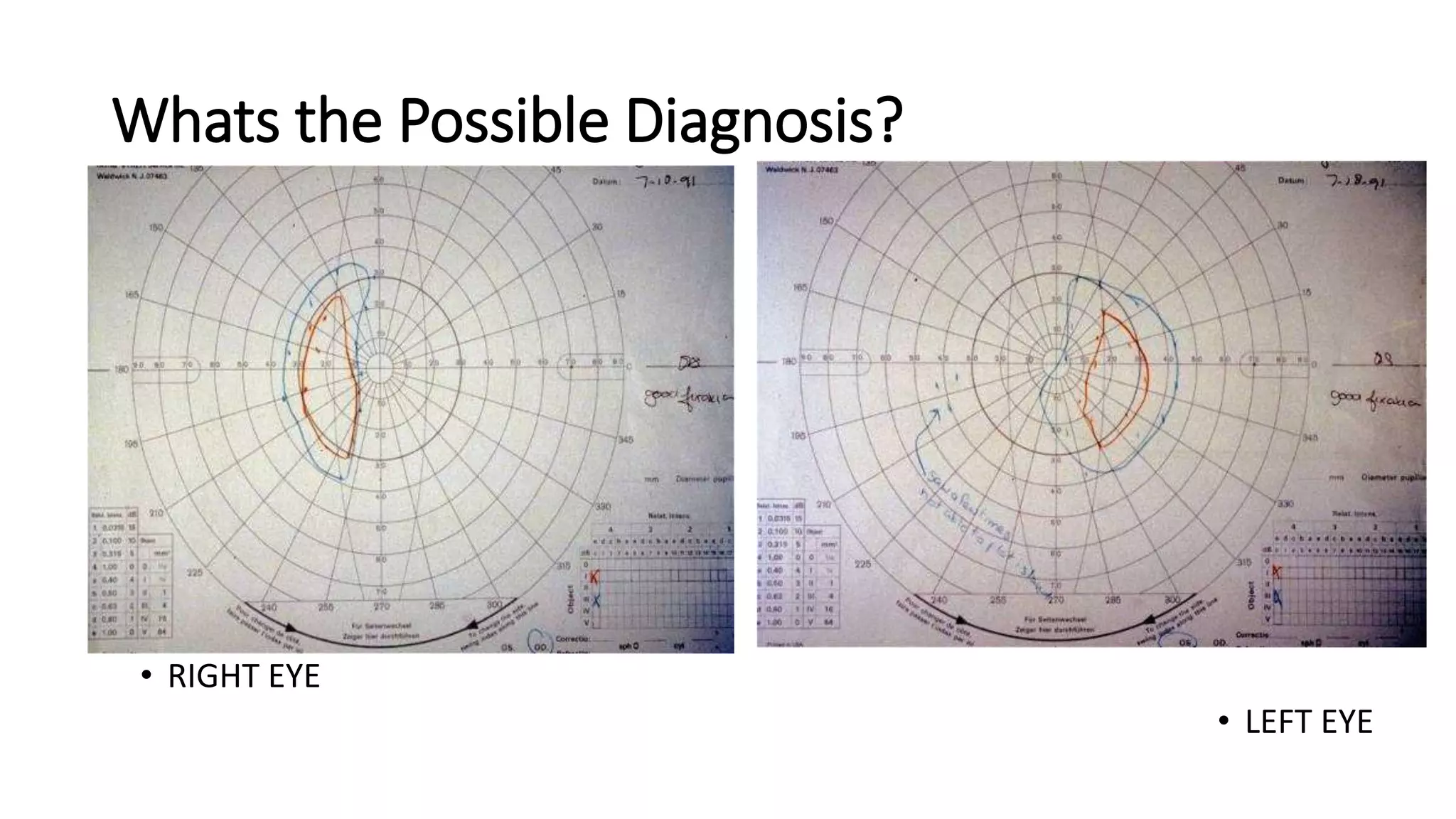Visual field basics & interpretation | PPTX | Eye and Vision Conditions ...