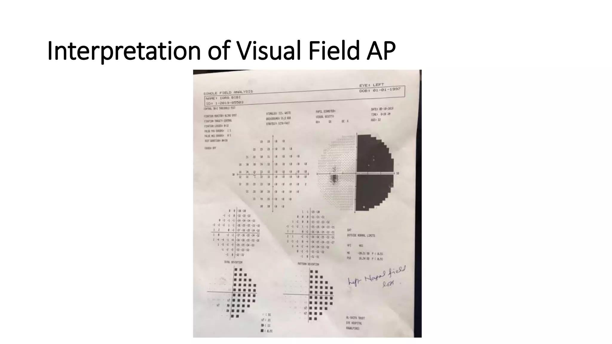 Visual field basics & interpretation | PPTX