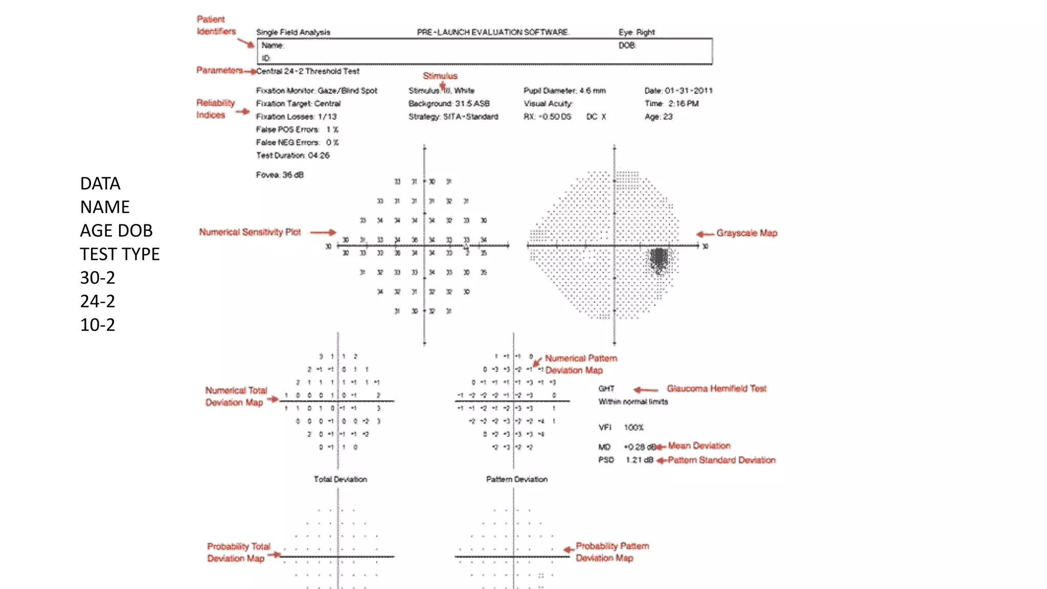 Visual field basics & interpretation | PPTX