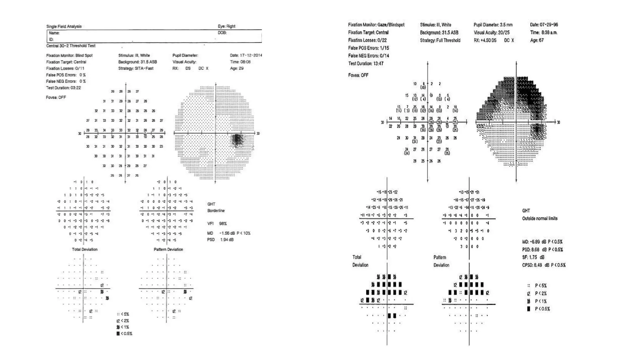 Visual field basics & interpretation | PPTX