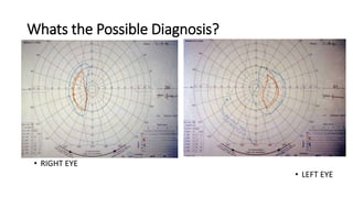 Visual field basics & interpretation | PPTX | Eye and Vision Conditions ...