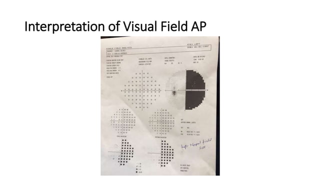 Visual field basics & interpretation | PPTX | Eye and Vision Conditions ...