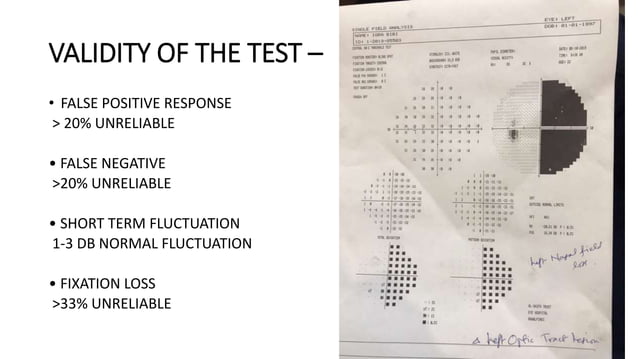 Visual field basics & interpretation | PPTX | Eye and Vision Conditions ...
