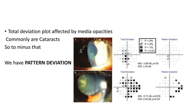 Visual field basics & interpretation | PPTX | Eye and Vision Conditions ...