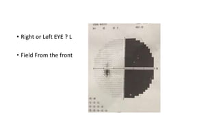 Visual field basics & interpretation | PPTX | Eye and Vision Conditions ...