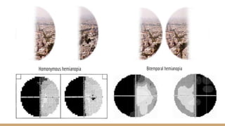 Visual field defects.pptx