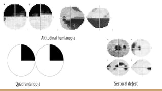Visual field defects.pptx