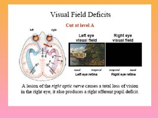 Visual field defects and light reflex | PPT