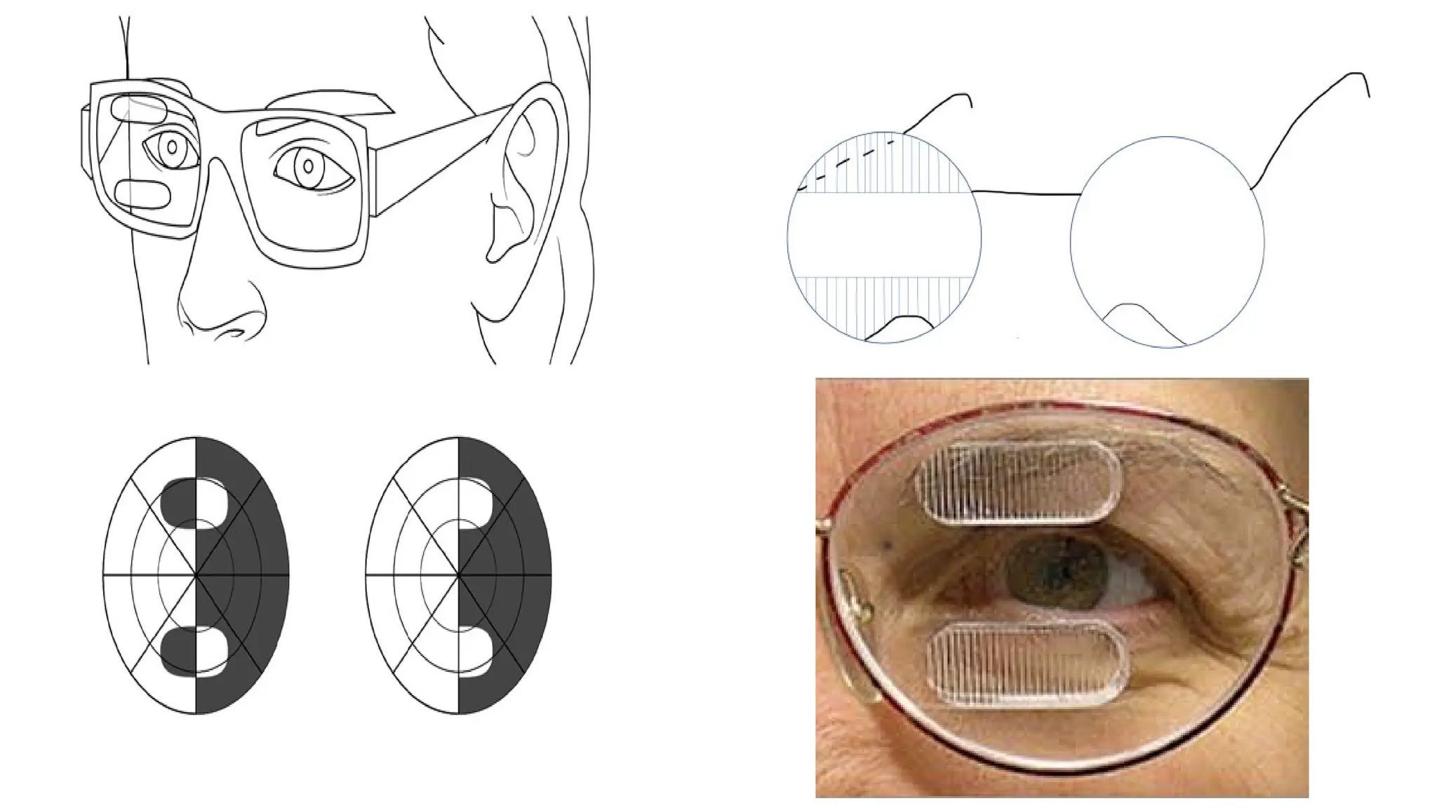 VISUAL FIELD ENHANCING TECHNIQUES FOR PATIENTS WITH HEMIANOPIA FIELD.pptx