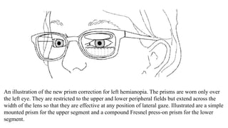 VISUAL FIELD ENHANCING TECHNIQUES FOR PATIENTS WITH HEMIANOPIA FIELD.pptx