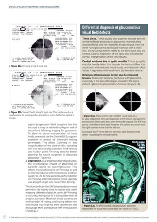 visual field interpretation 1.pdf