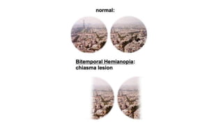 Visual field report | PPT