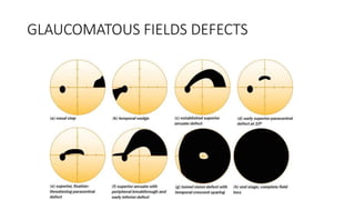 VISUAL FIELDS and perimetry interpretation | PPTX