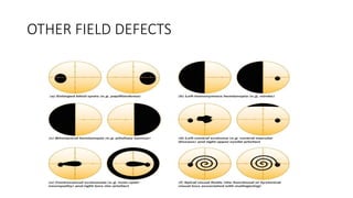VISUAL FIELDS , PERIMETRY, INTERPRETATION | PPTX
