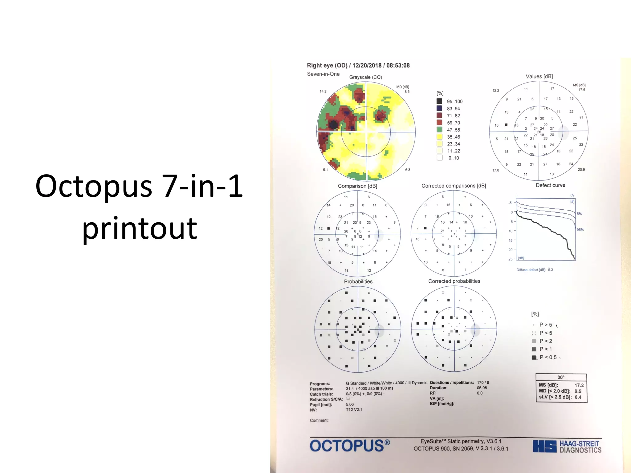 Interpretation of visual fields with special reference to octopus | PDF