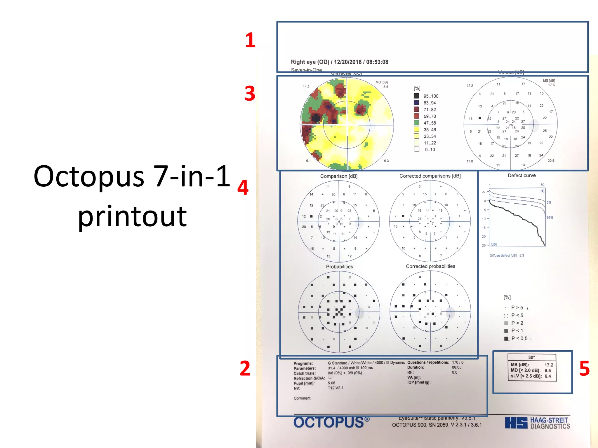 Interpretation of visual fields with special reference to octopus | PDF
