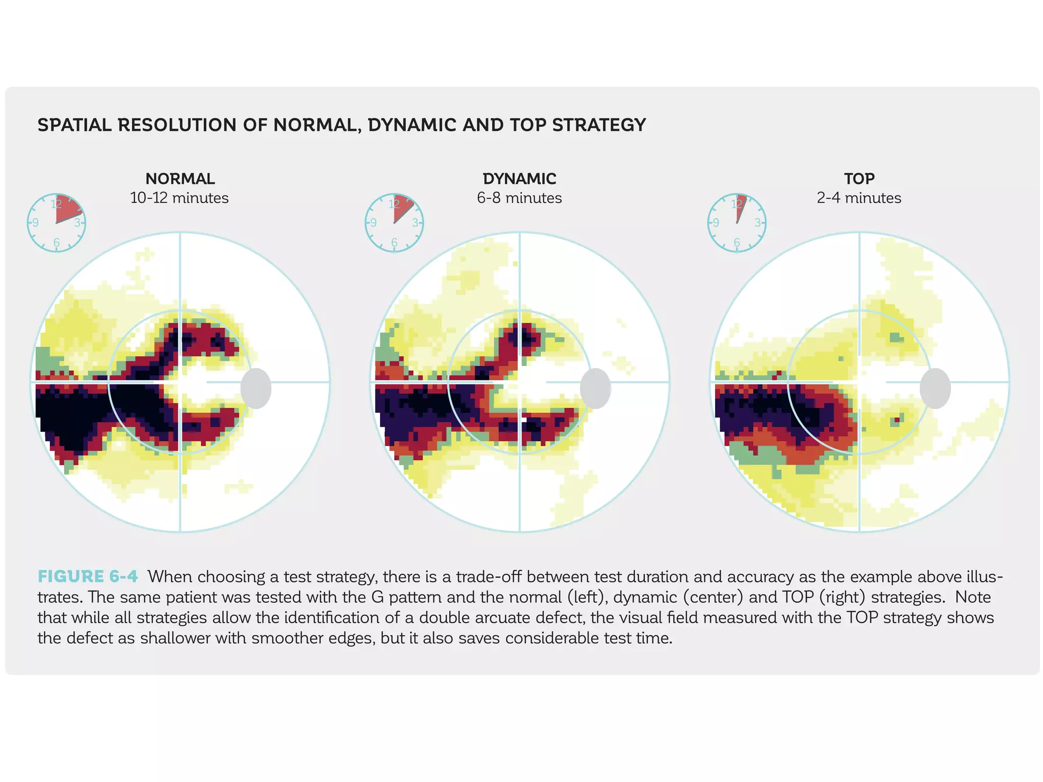 Interpretation of visual fields with special reference to octopus | PDF