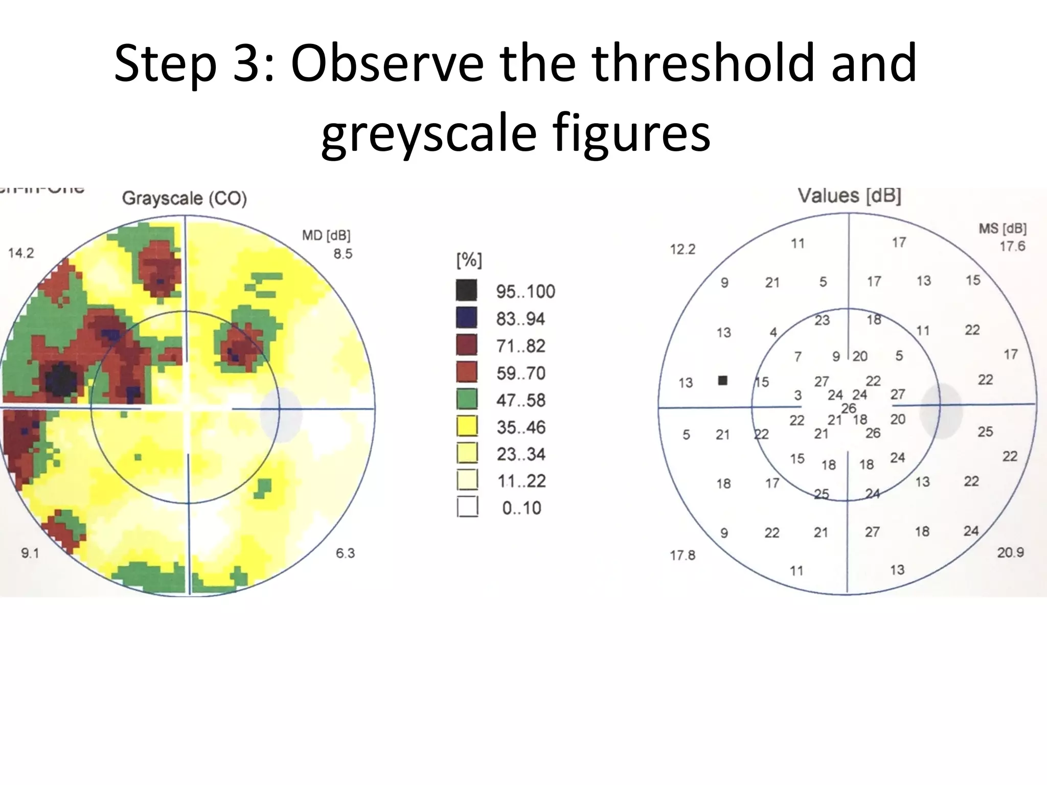Interpretation of visual fields with special reference to octopus | PDF