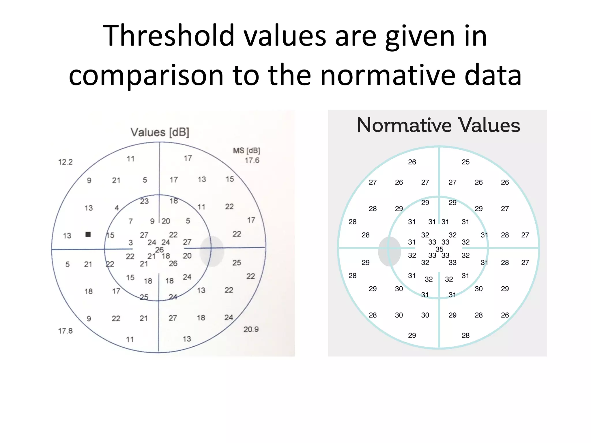 Interpretation of visual fields with special reference to octopus | PDF