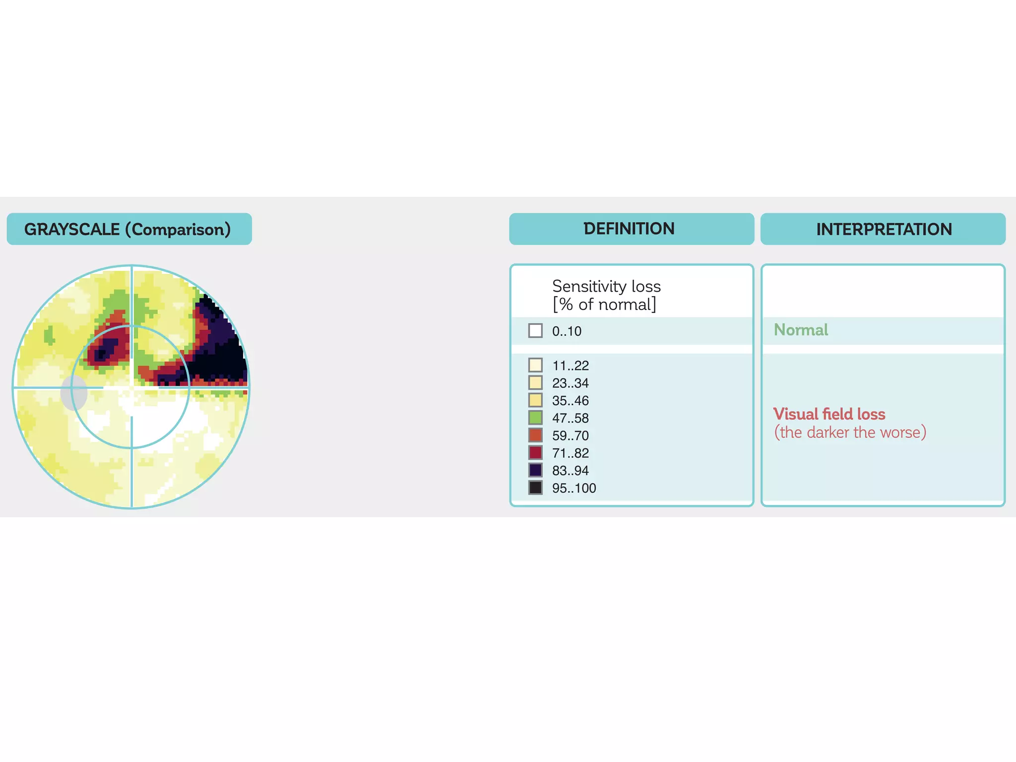 Interpretation of visual fields with special reference to octopus | PDF