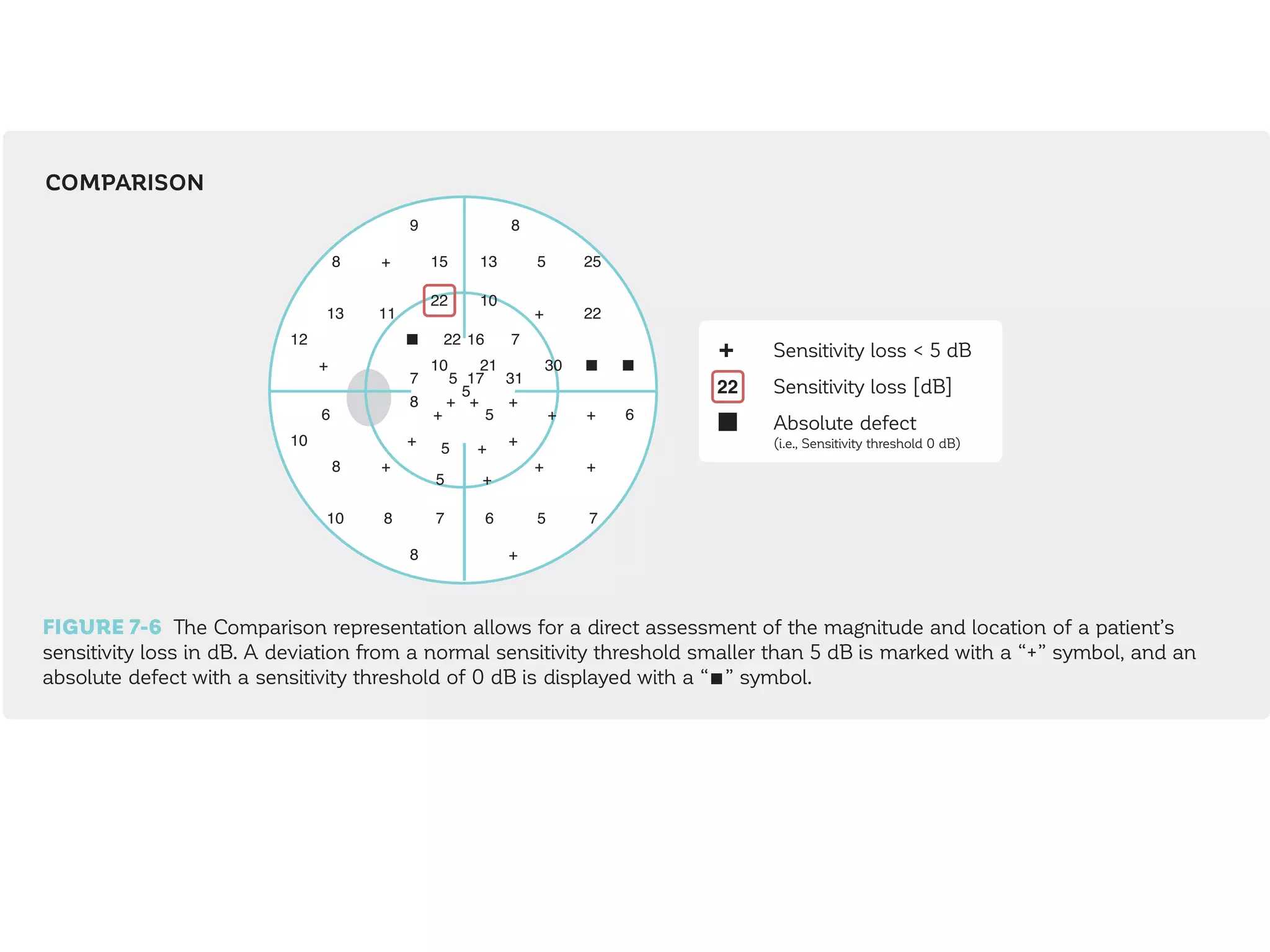 Interpretation of visual fields with special reference to octopus | PDF
