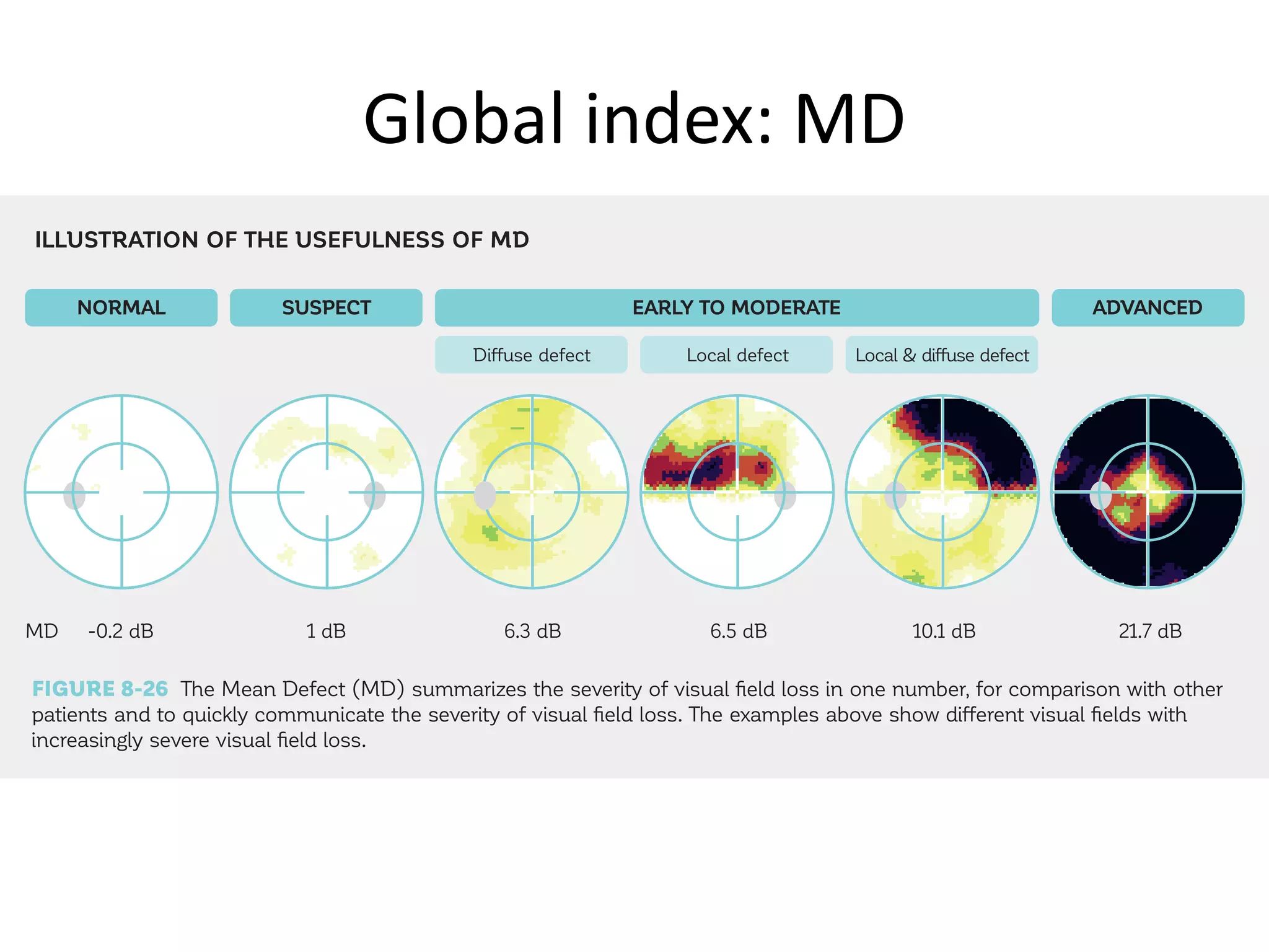 Interpretation of visual fields with special reference to octopus | PDF