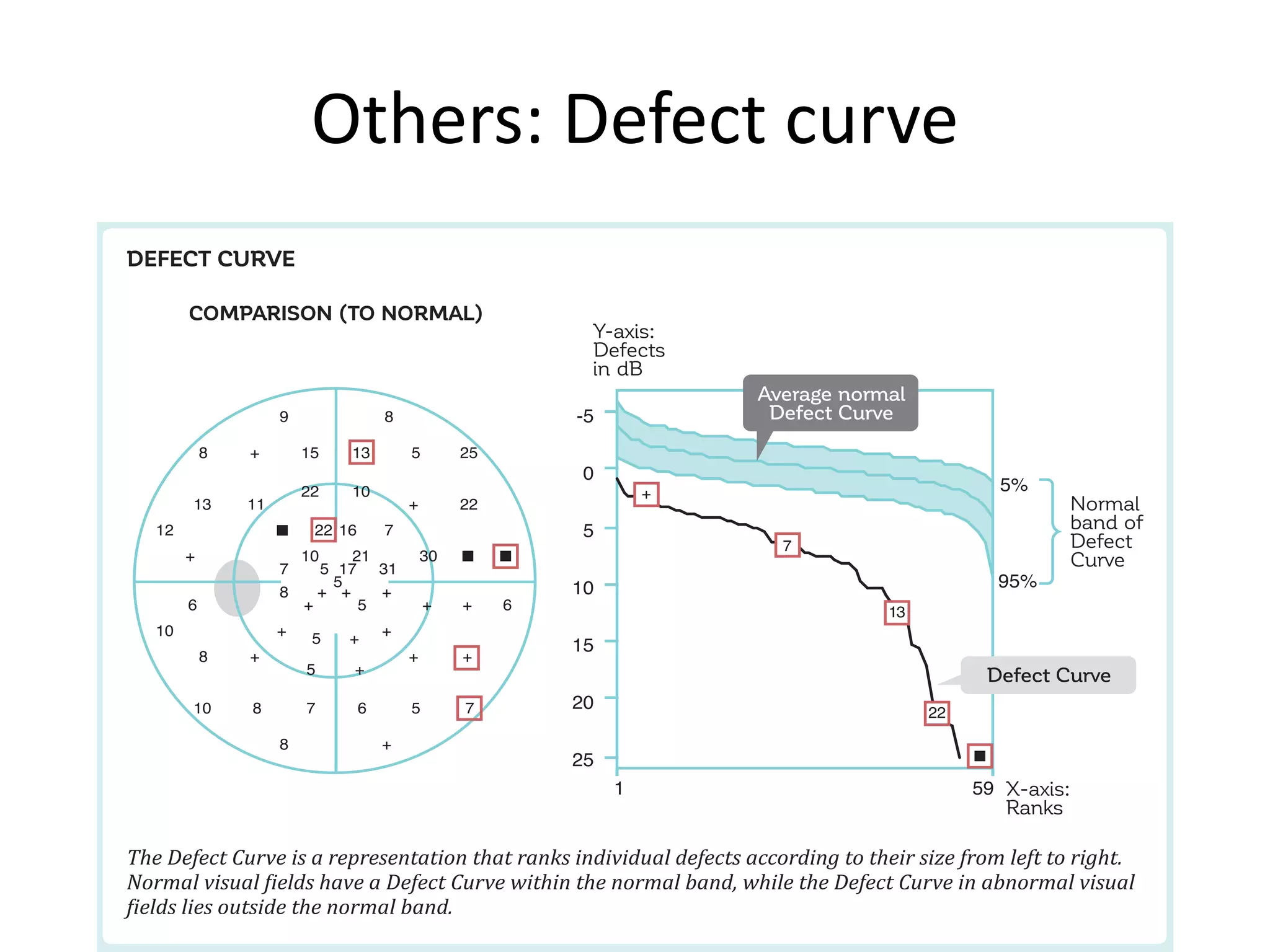 Interpretation of visual fields with special reference to octopus | PDF
