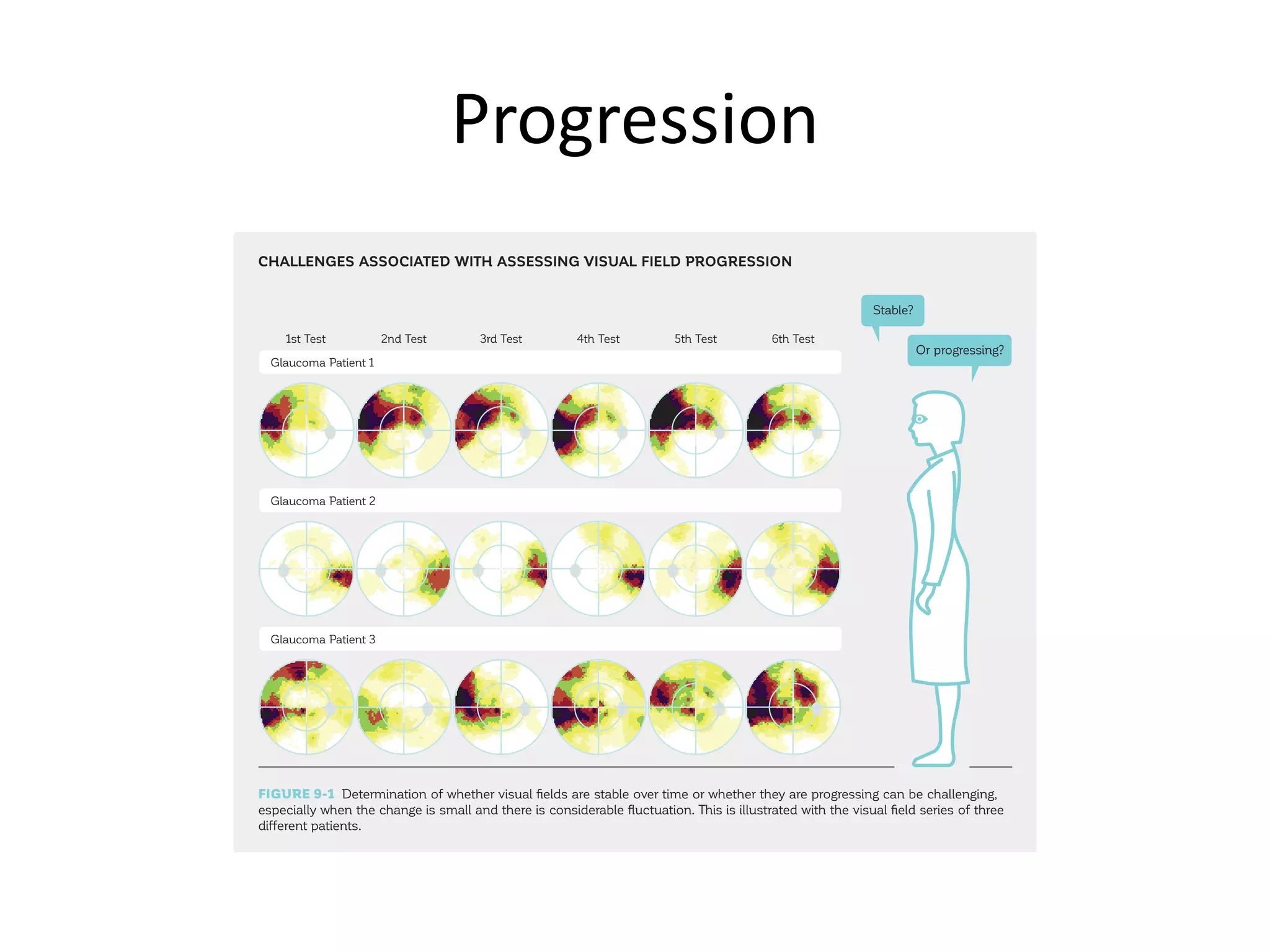 Interpretation of visual fields with special reference to octopus | PDF
