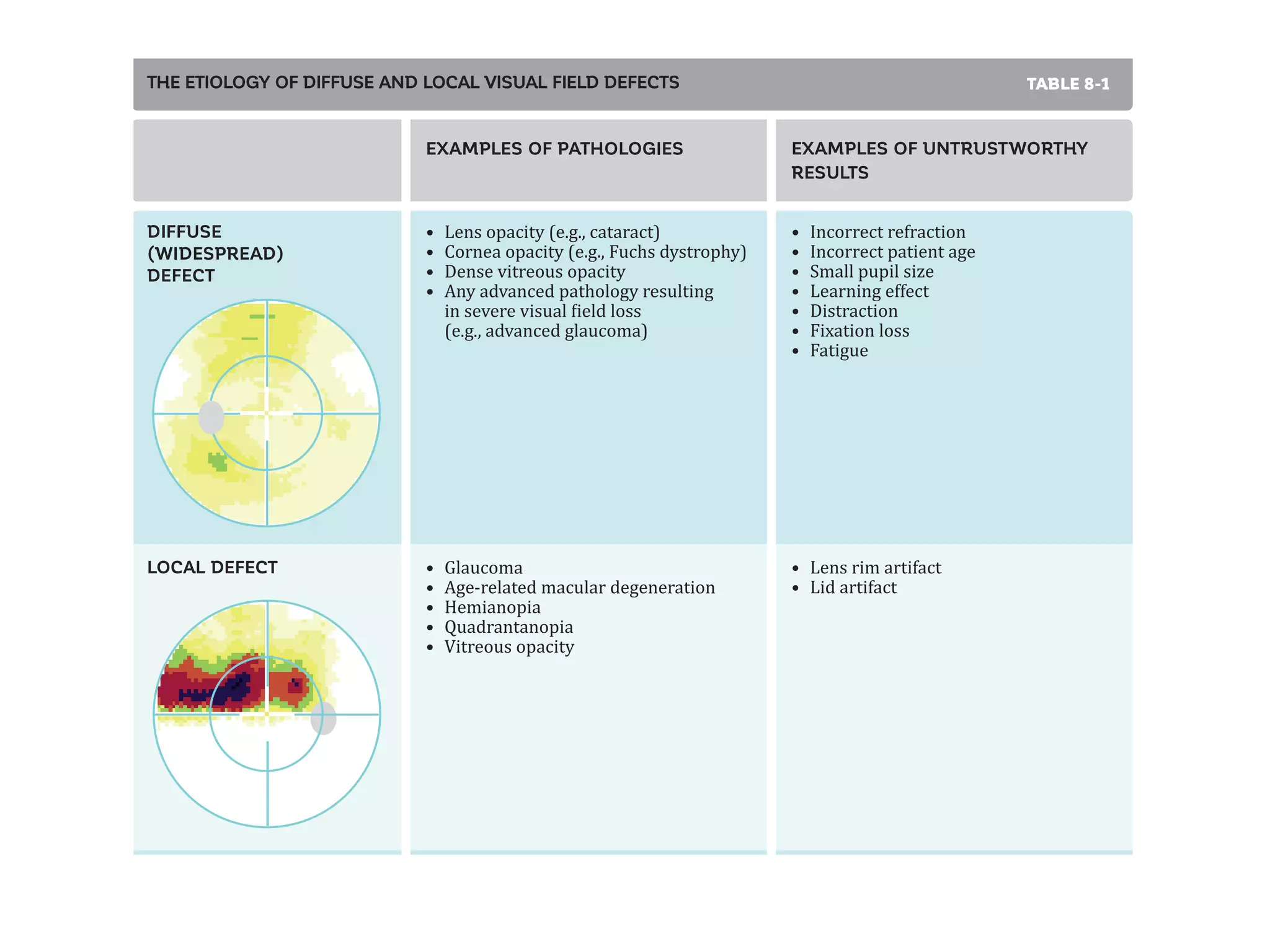 Interpretation of visual fields with special reference to octopus | PDF