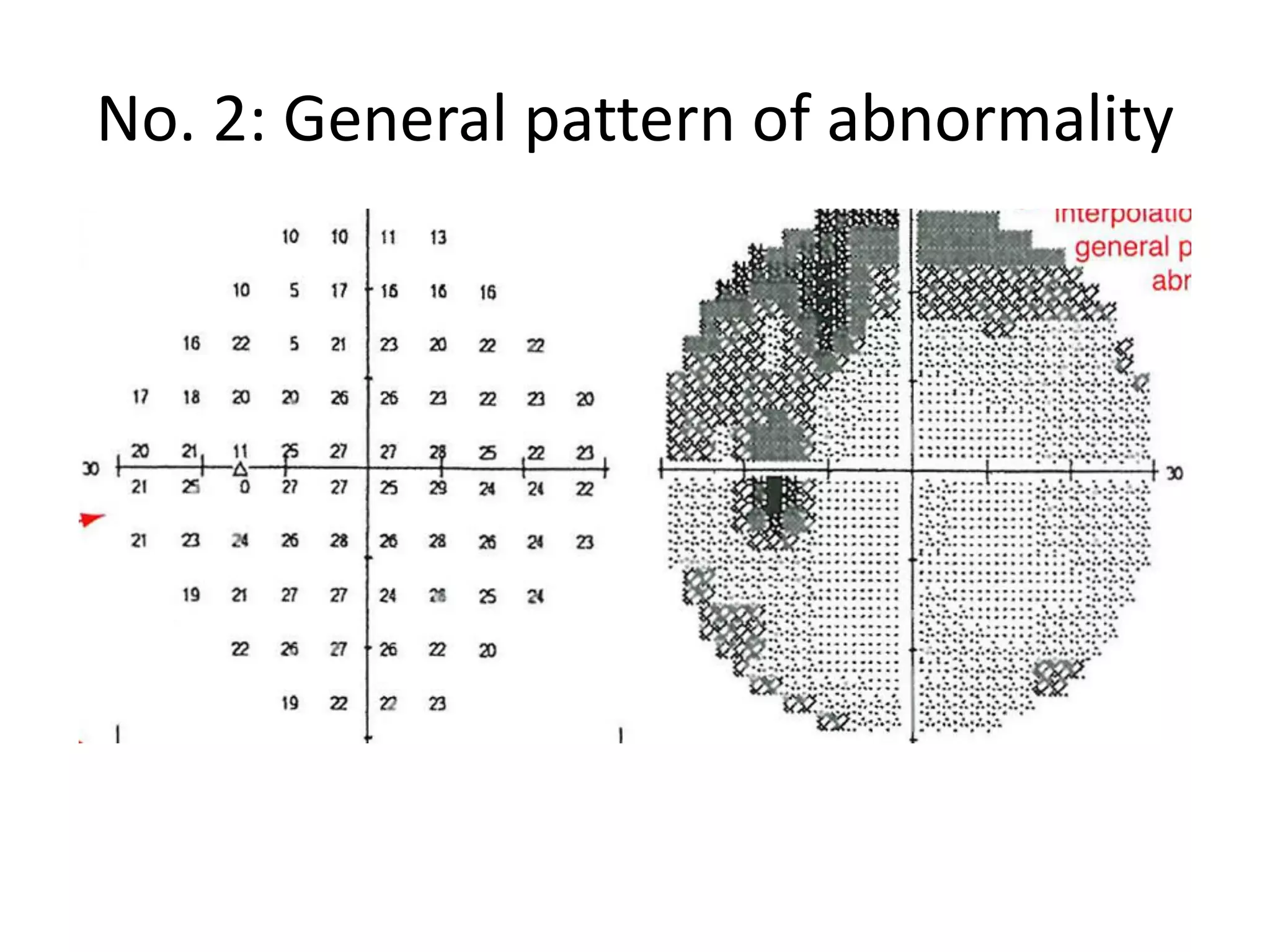 Interpretation of visual fields with special reference to octopus | PDF