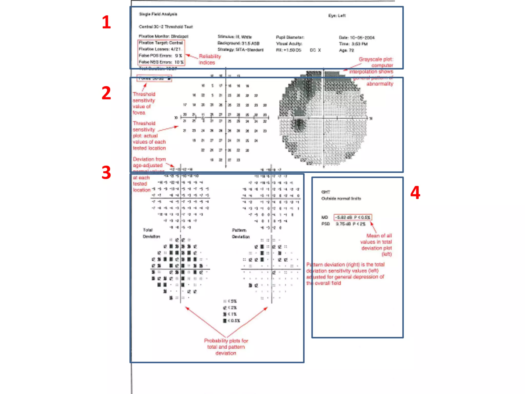 Interpretation of visual fields with special reference to octopus | PDF