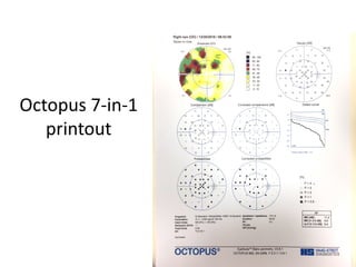 Interpretation of visual fields with special reference to octopus | PDF