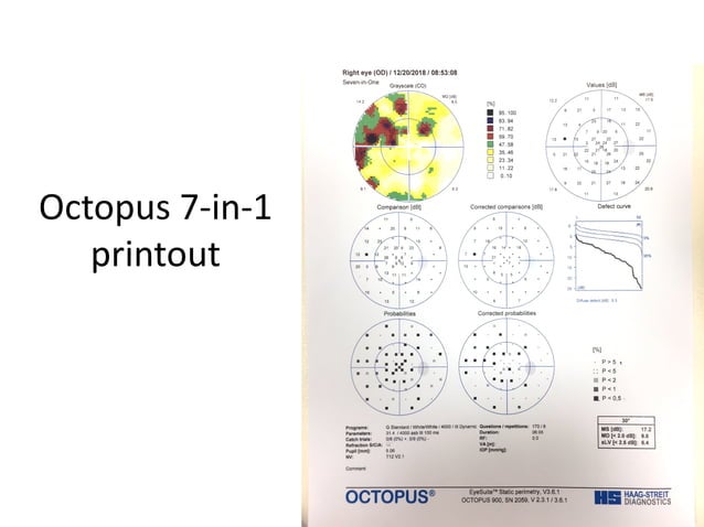 Interpretation of visual fields with special reference to octopus | PDF