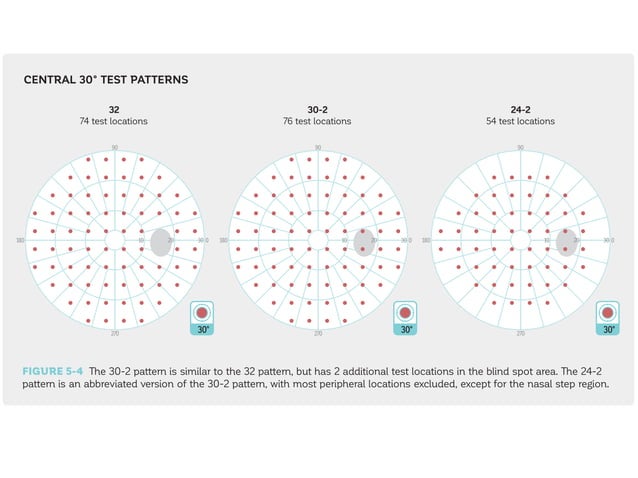 Interpretation of visual fields with special reference to octopus | PDF