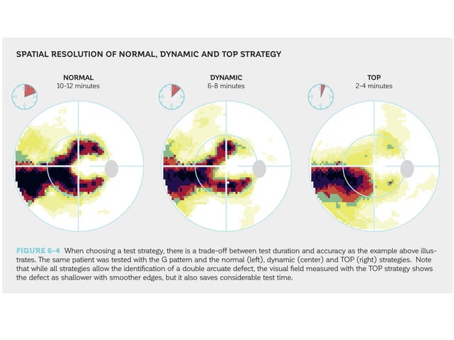 Interpretation of visual fields with special reference to octopus | PDF
