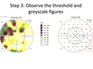 Interpretation of visual fields with special reference to octopus | PDF