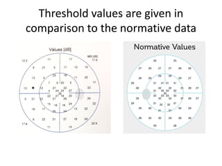 Interpretation of visual fields with special reference to octopus | PDF