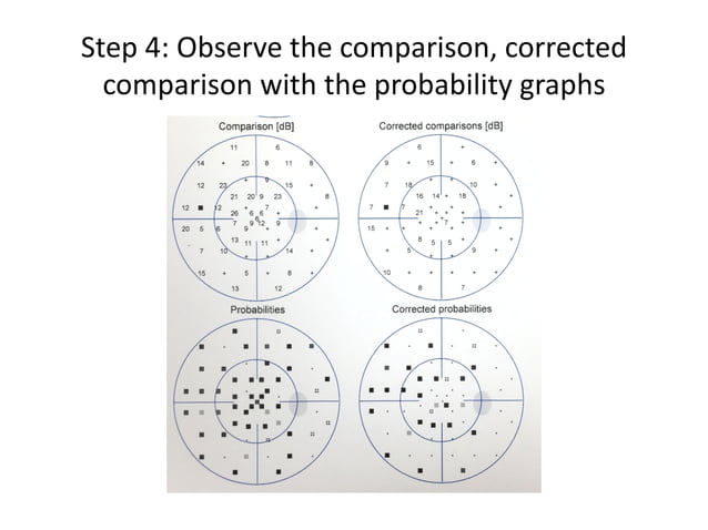 Interpretation of visual fields with special reference to octopus | PDF