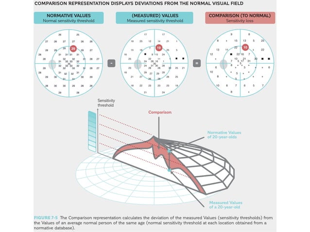 Interpretation of visual fields with special reference to octopus | PDF