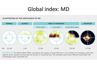 Interpretation of visual fields with special reference to octopus | PDF