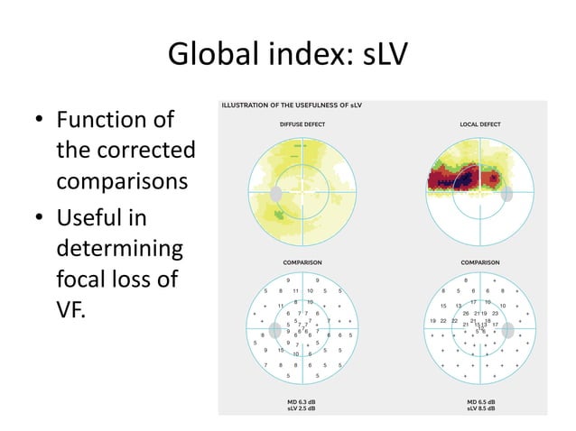 Interpretation of visual fields with special reference to octopus | PDF