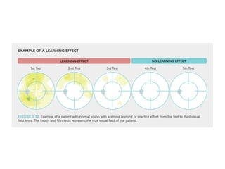 Interpretation of visual fields with special reference to octopus | PDF