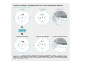Interpretation of visual fields with special reference to octopus | PDF