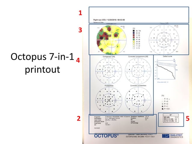 Interpretation of visual fields with special reference to octopus