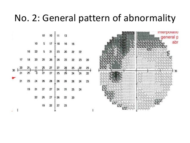 Interpretation of visual fields with special reference to octopus